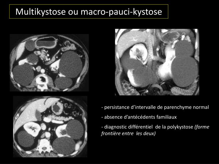 PPT - Maladies kystiques rénales PowerPoint Presentation - ID:383629