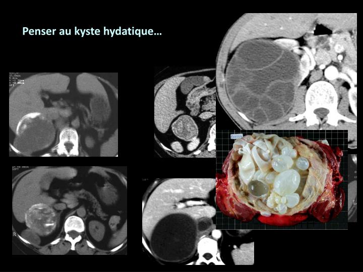 PPT - Maladies kystiques rénales PowerPoint Presentation - ID:383629