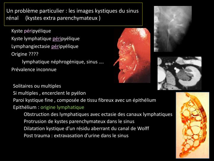 PPT - Maladies kystiques rénales PowerPoint Presentation - ID:383629
