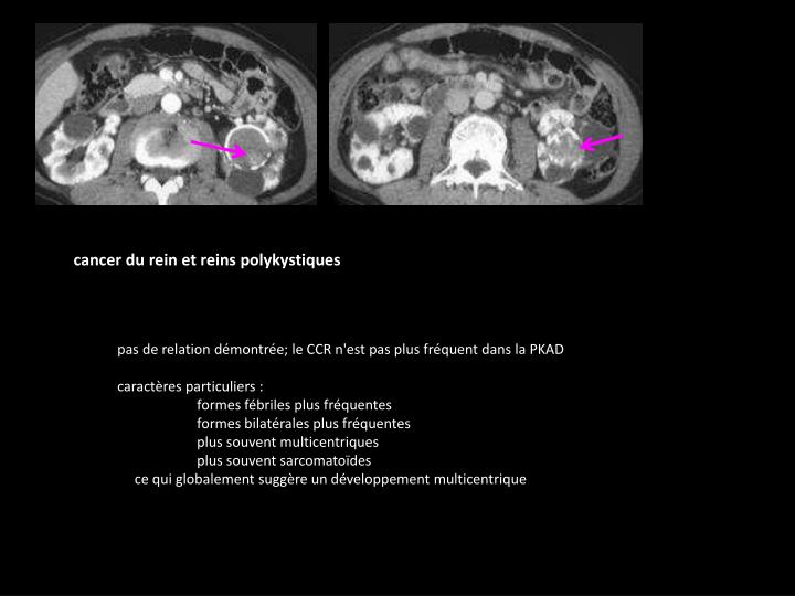 PPT - Maladies kystiques rénales PowerPoint Presentation - ID:383629