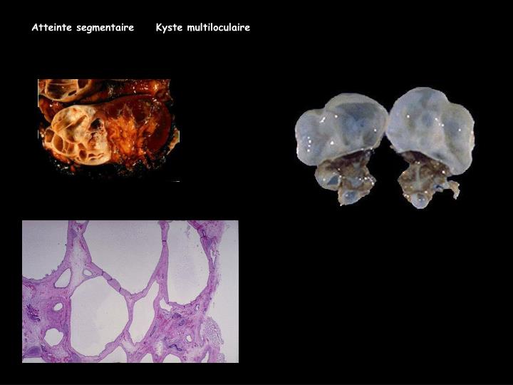 PPT - Maladies kystiques rénales PowerPoint Presentation - ID:383629