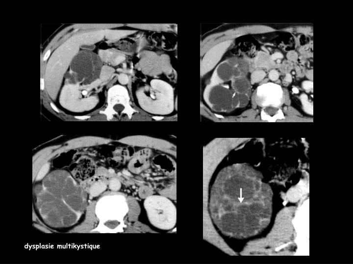 PPT - Maladies kystiques rénales PowerPoint Presentation - ID:383629