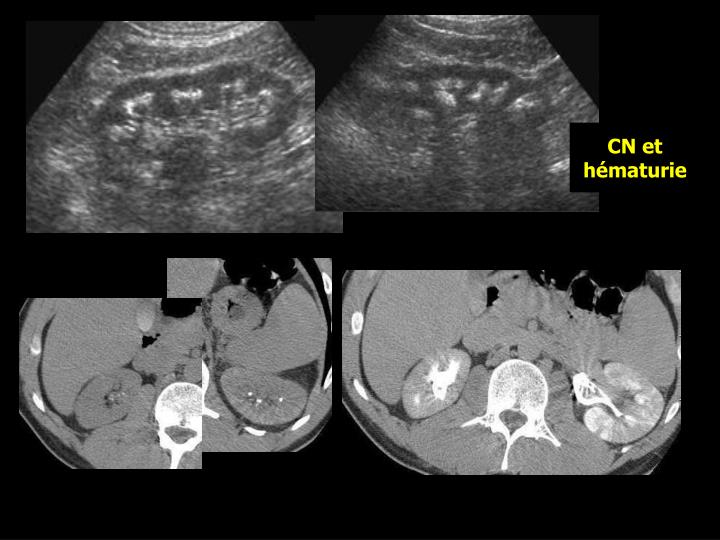 PPT - Maladies kystiques rénales PowerPoint Presentation - ID:383629