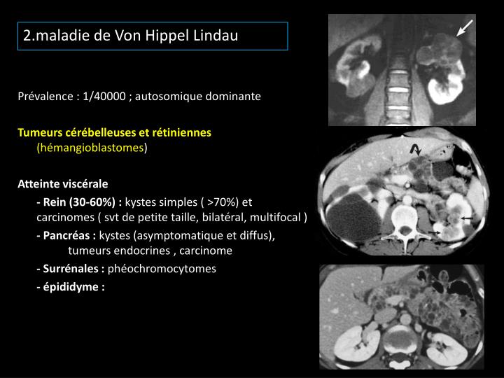 PPT - Maladies kystiques rénales PowerPoint Presentation - ID:383629