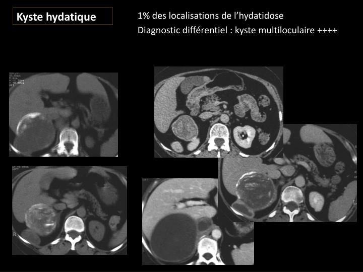PPT - Maladies kystiques rénales PowerPoint Presentation - ID:383629