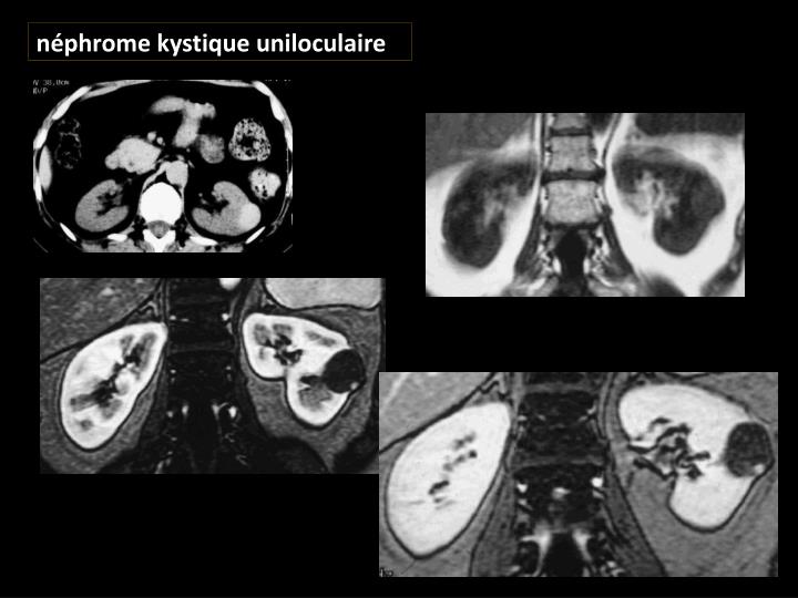 PPT - Maladies kystiques rénales PowerPoint Presentation - ID:383629