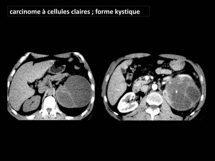 PPT - Maladies kystiques rénales PowerPoint Presentation - ID:383629