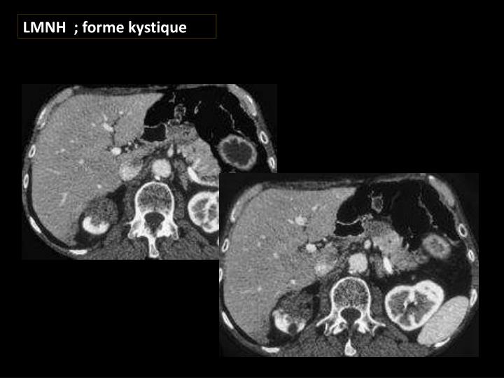 PPT - Maladies kystiques rénales PowerPoint Presentation - ID:383629