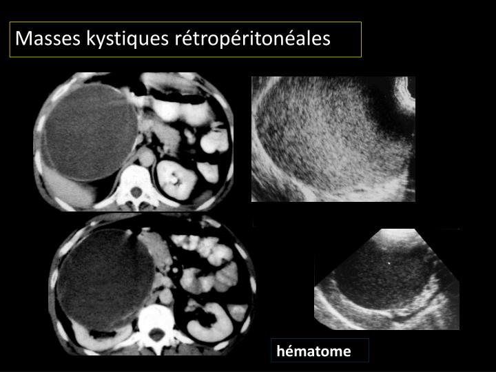 PPT - Maladies kystiques rénales PowerPoint Presentation - ID:383629