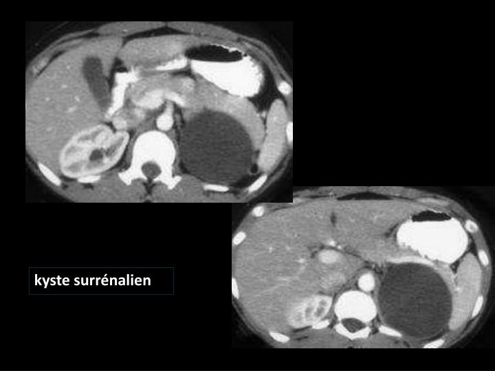 PPT - Maladies kystiques rénales PowerPoint Presentation - ID:383629