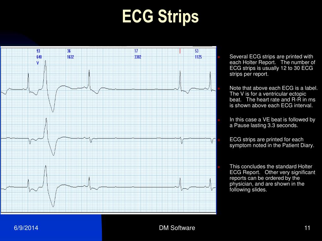 PPT - Reading the Holter ECG Report PowerPoint Presentation, free ... PPT - Reading the Holter ECG Report PowerPoint Presentation, free ...