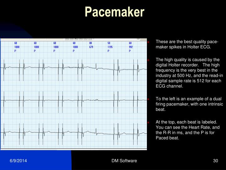 PPT - Reading the Holter ECG Report PowerPoint Presentation - ID:384785