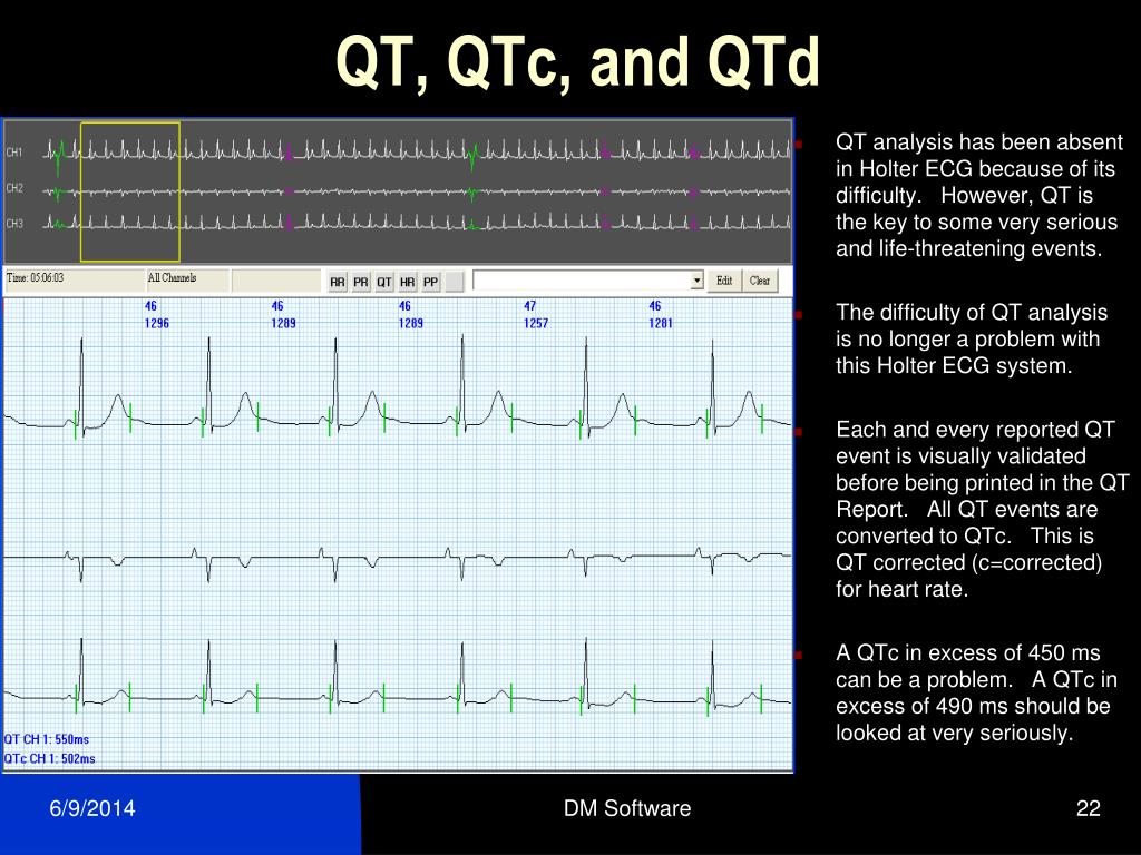 PPT - Reading the Holter ECG Report PowerPoint Presentation, free ... PPT - Reading the Holter ECG Report PowerPoint Presentation, free ...