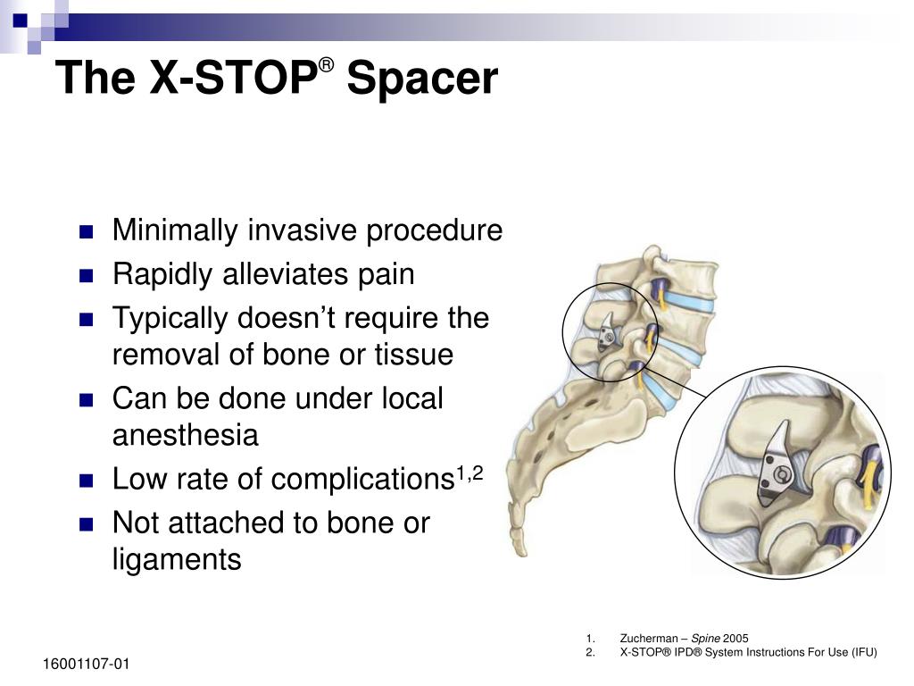 PPT - Lumbar Spinal Stenosis: Symptoms and Treatment PowerPoint ...