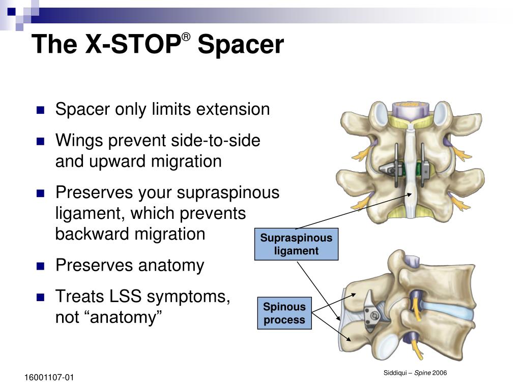 PPT - Lumbar Spinal Stenosis: Symptoms and Treatment PowerPoint ...