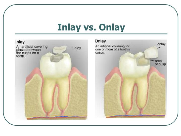 PPT - Identifying and Charting Restorations PowerPoint Presentation ...