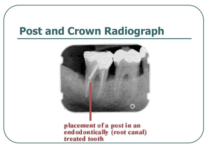 PPT - Identifying and Charting Restorations PowerPoint Presentation ...