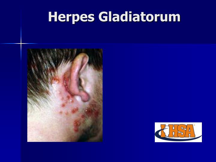PPT - Common skin conditions in wrestling PowerPoint Presentation - ID ...