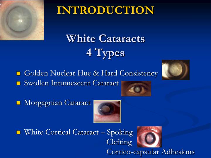 PPT - PHACOEMULSIFICATION IN INTUMESCENT MATURE CATARACT: Managing a ...