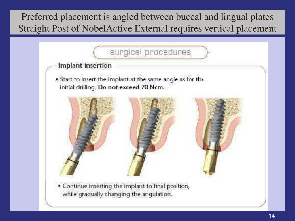 PPT - NobelActive Internal and External Hex Implants Nobel Marketing ...