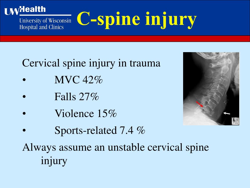 PPT - Airway Management in Trauma Trauma Conference UW Hospital and ...
