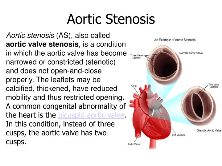 PPT - Aortic Valve Disease PowerPoint Presentation - ID:391667
