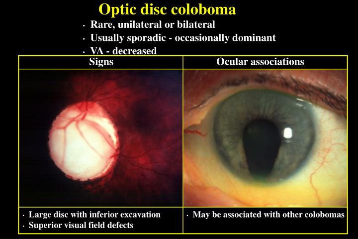 PPT - CONGENITAL OPTIC NERVE ANOMALIES PowerPoint Presentation - ID:391991