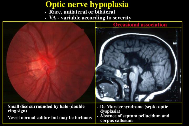 PPT - CONGENITAL OPTIC NERVE ANOMALIES PowerPoint Presentation - ID:391991
