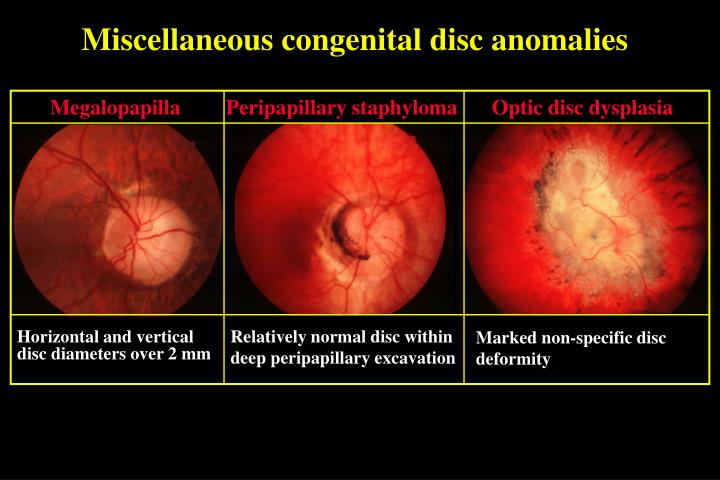 PPT - CONGENITAL OPTIC NERVE ANOMALIES PowerPoint Presentation - ID:391991