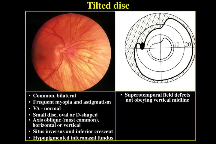PPT - CONGENITAL OPTIC NERVE ANOMALIES PowerPoint Presentation - ID:391991