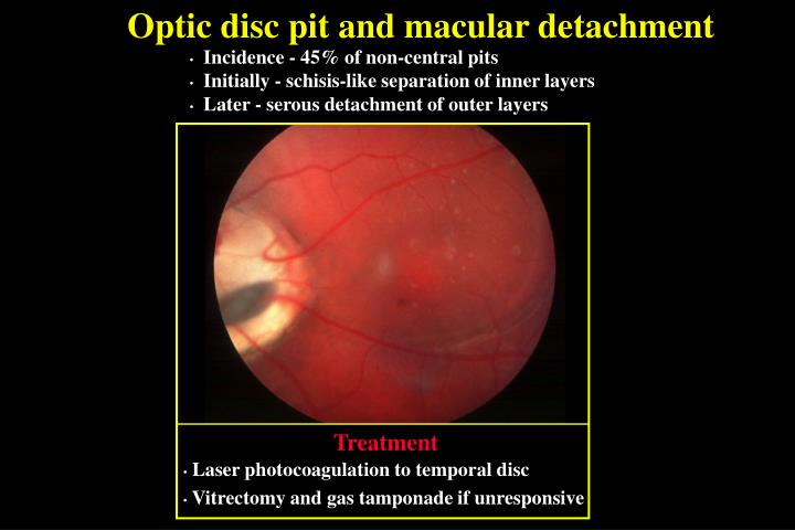 PPT - CONGENITAL OPTIC NERVE ANOMALIES PowerPoint Presentation - ID:391991
