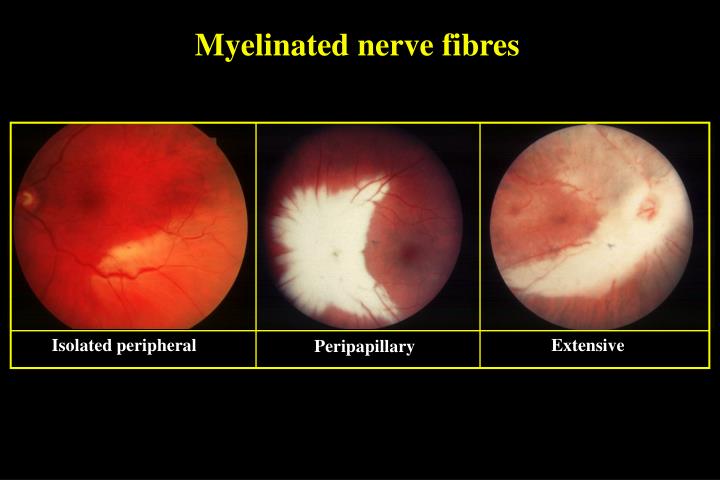 PPT - CONGENITAL OPTIC NERVE ANOMALIES PowerPoint Presentation - ID:391991