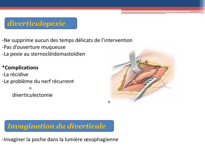 PPT - DIVERTICULE DE ZENKER DIAGNOSTIC ET TRAITEMENT Dr.M.BOUMENDJEL Dr ...