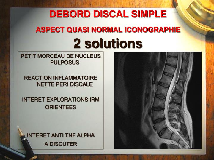 PPT - MA VISION DE LA MALADIE DISCALE PowerPoint Presentation - ID:392639