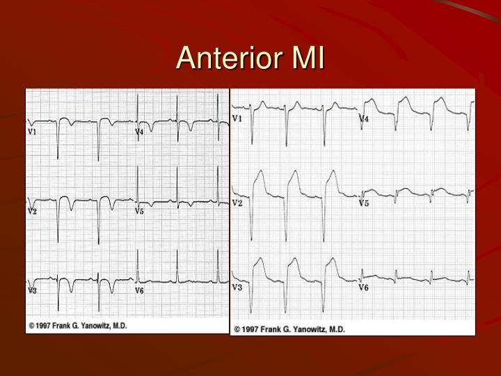 PPT - EKG Myocardial infarction and other ischemic states PowerPoint ...