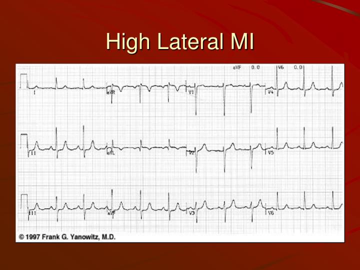 PPT - EKG Myocardial infarction and other ischemic states PowerPoint ...
