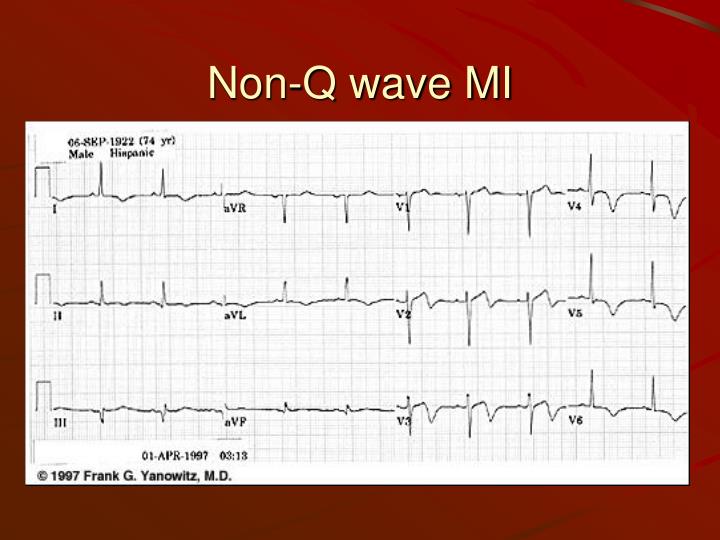 PPT - EKG Myocardial infarction and other ischemic states PowerPoint ...