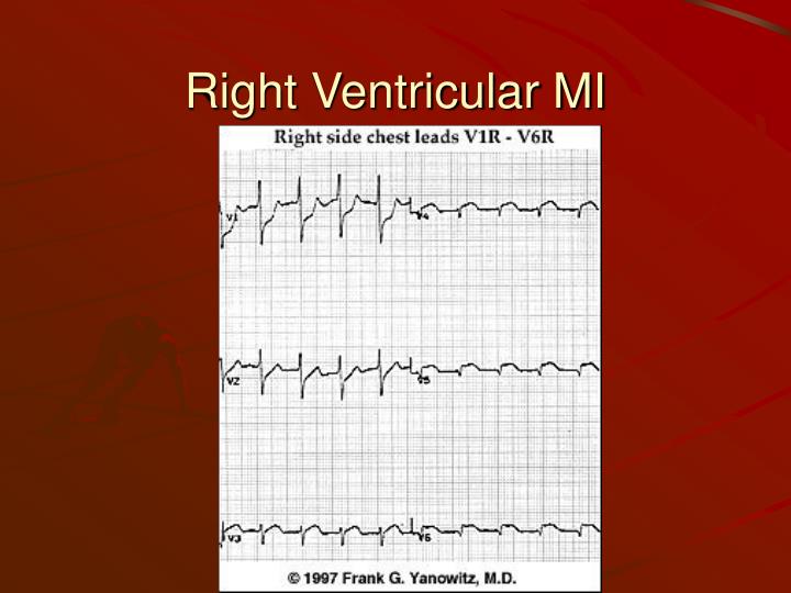 PPT - EKG Myocardial infarction and other ischemic states PowerPoint ...