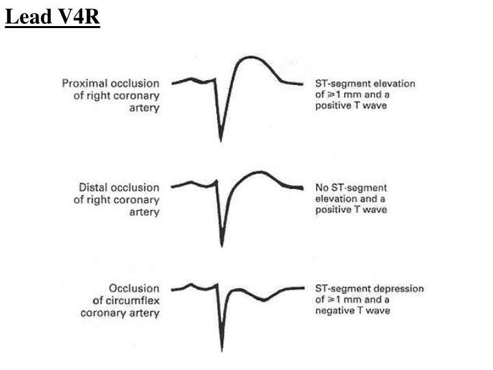 PPT - Right ventricle infarction PowerPoint Presentation - ID:393092