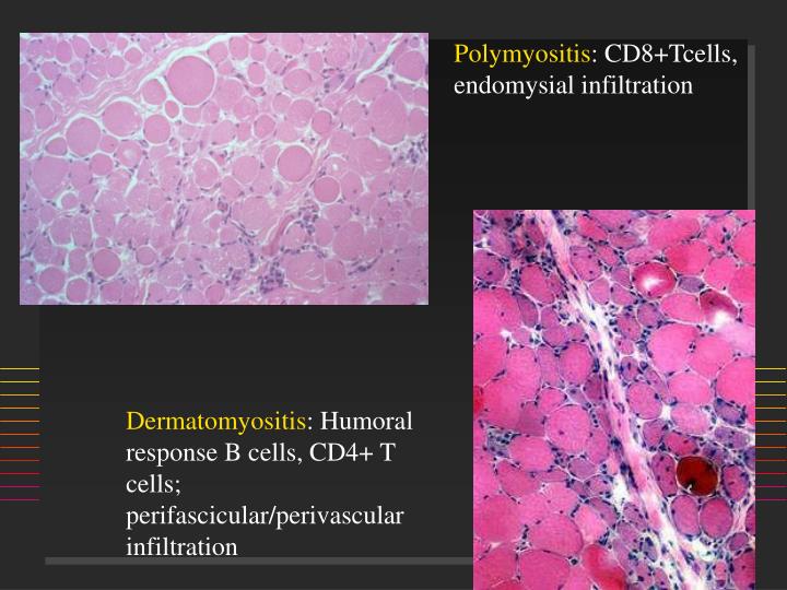 PPT - Scleroderma and Inflammatory Myositis PowerPoint Presentation ...