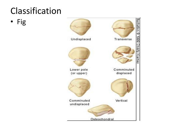 PPT - Fracture of the patella PowerPoint Presentation - ID:394804