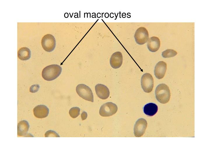 PPT - Macrocytic anemia: B12 & folate PowerPoint Presentation - ID:396268