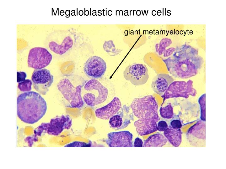 PPT - Macrocytic anemia: B12 & folate PowerPoint Presentation - ID:396268