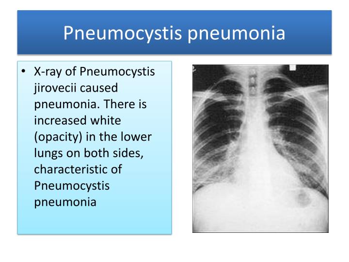 PPT - AIDS BY DR BASHIR SOPORE KASHMIR PowerPoint Presentation - ID:396766