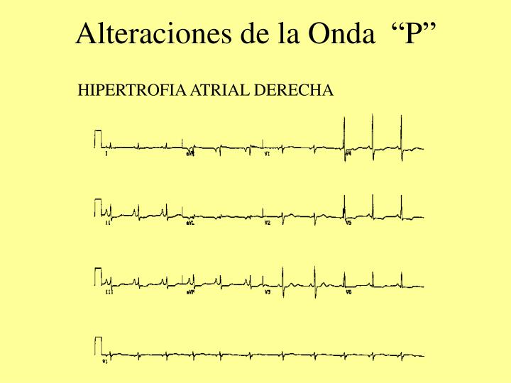 PPT - ALTERACIONES EN LAS ONDAS DEL ELECTROCARDIOGRAMA PowerPoint ...