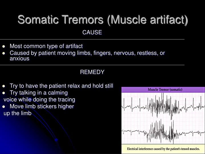 PPT - ECG TRAINING MODULE 2 PowerPoint Presentation - ID:400708