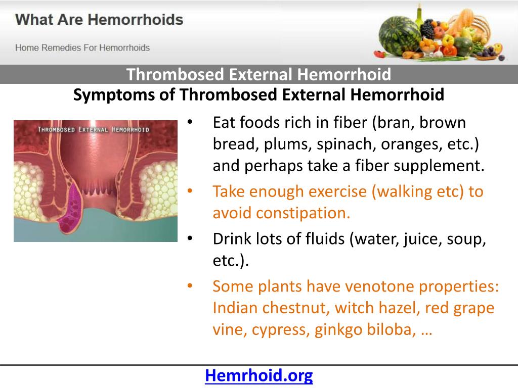 Ppt Thrombosed External Hemorrhoid Treatment Powerpoint Presentation