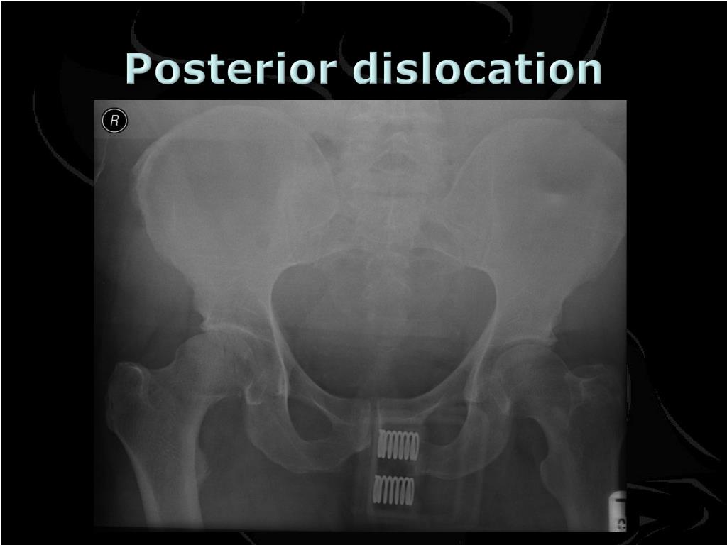 PPT - Is the Application of Pelvic Binders by Pre-Hospital Care ...