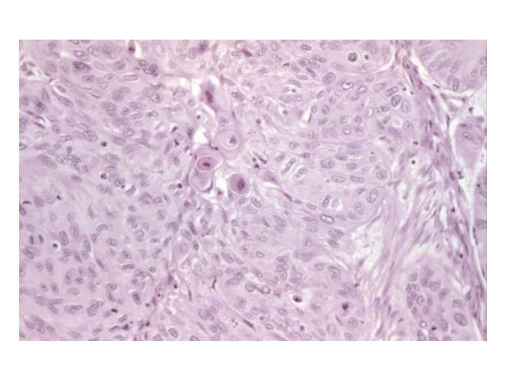 PPT - Squamous cell carcinoma PowerPoint Presentation, free download ...