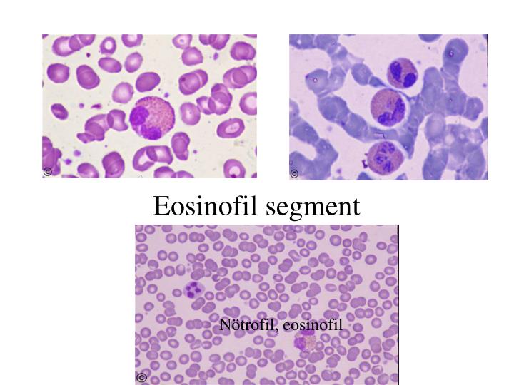 PPT - KEMİK İLİĞİ ve PERİFERİK YAYMA ÖRNEKLERİ PowerPoint Presentation - ID:412832